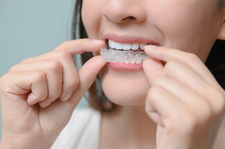 Getting Off-Track With Your Invisalign Timeline? Here Are 3 Tips to ...