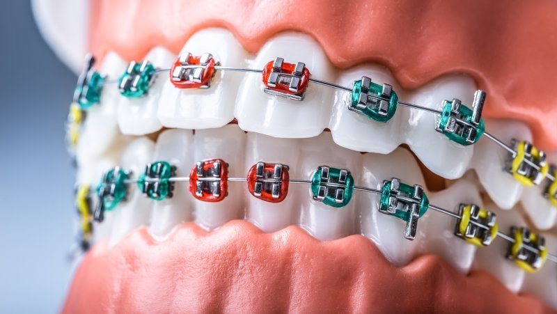 4 Important Factors That Affect the Price of Orthodontics | Shirck ...
